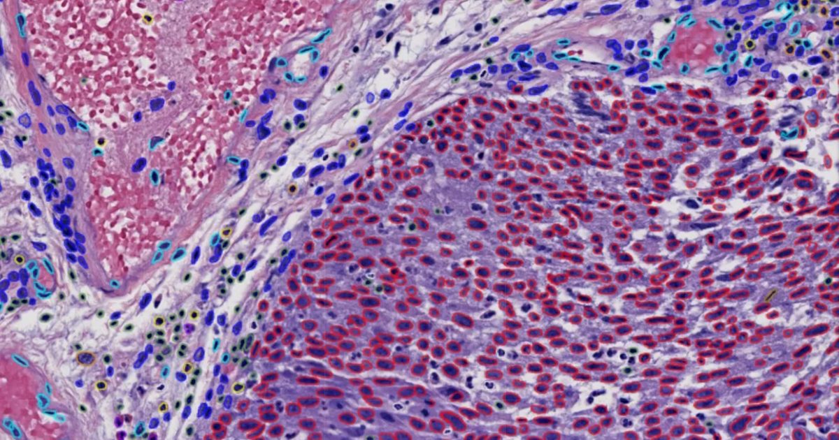 DCVC | Valar Labs introduces a smarter cancer test